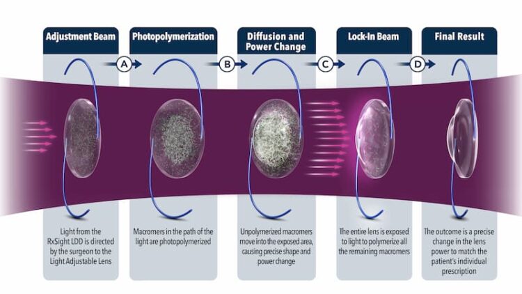 Light Adjustable Lens | Laurel Eye Clinic